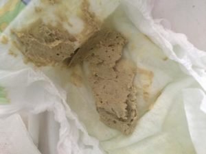 Clay Colored Stool - Pictures, Look Like, Causes, Treatment, Diagnosis