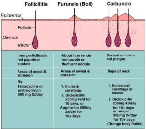 Furuncle - Definition, Treatment, Vs Carbuncle, What is, Pictures