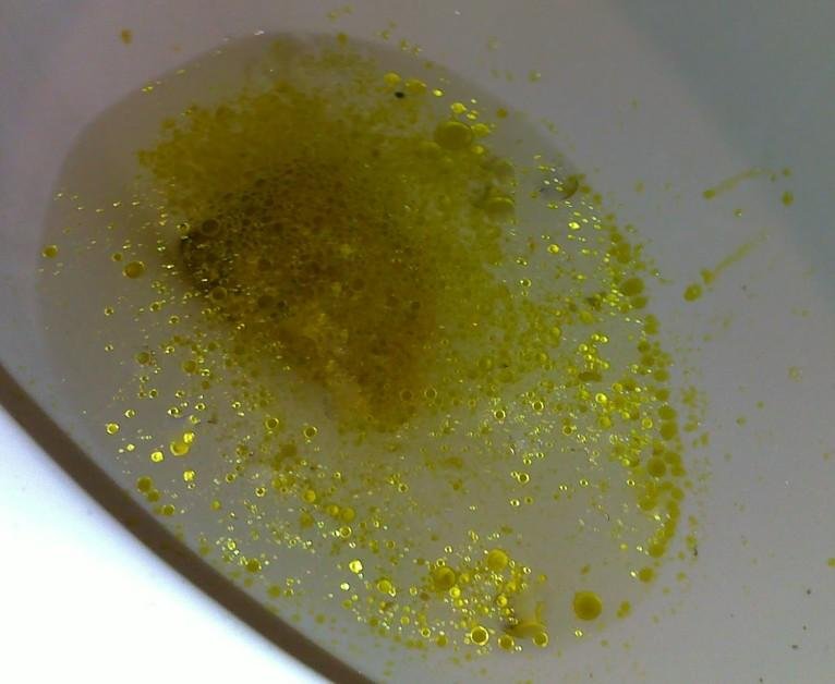 Steatorrhea - Pictures, Definition, Symptoms, Causes, Treatment