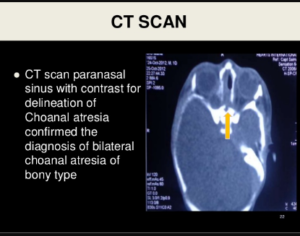 Choanal Atresia - Unilateral & Bilateral, Symptoms, Causes & Types