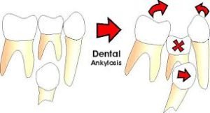 Ankylosis - Definition, What is?, Causes, Symptoms, Diagnosis, Treatment