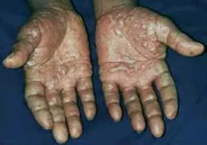 Pompholyx (Dyshidrotic Eczema) - Treatment, Causes, Signs & Symptoms